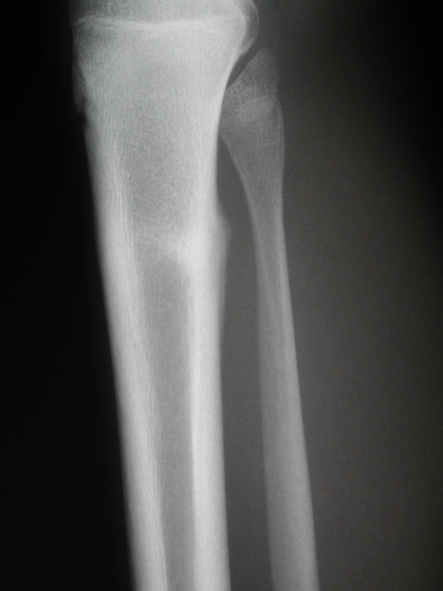 Stress Fracture X Ray Tibia Stress Fracture X Ray Tibia